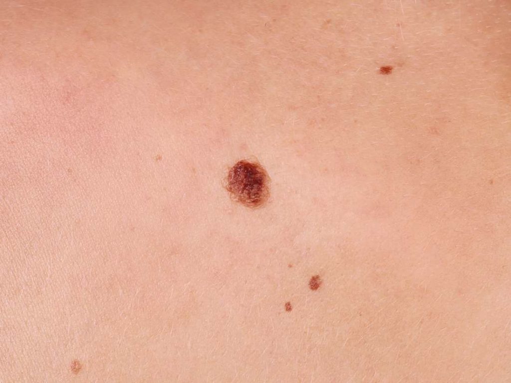 How to Remove Red Moles on Skin - 2024 Guide - Ferguson Action 2024